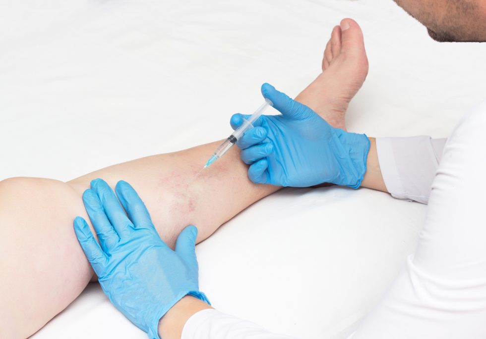 Nationally Recognized Vein Doctor | What’s the Best Plan for Vein ...